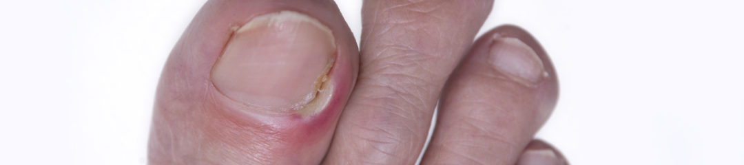Ingrown Toenails | Associate Foot Specialists Clinic